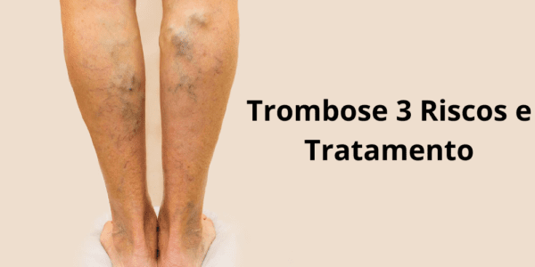 Trombose nas Pernas: 3 riscos, Sintomas e Diagnóstico